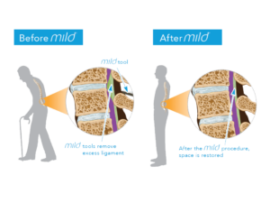 Minimally Invasive Lumbar Decompression (MILD®) Procedure Summary ...