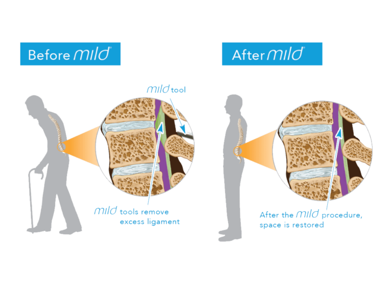 Minimally Invasive Lumbar Decompression (MILD®) Procedure Summary ... Minimally Invasive Lumbar Decompression (MILD®) Procedure Summary ...